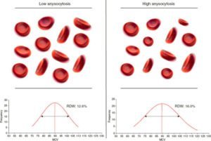 Anisocytosis