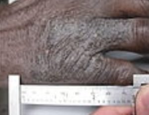 Lichenification