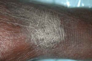 Lichenification